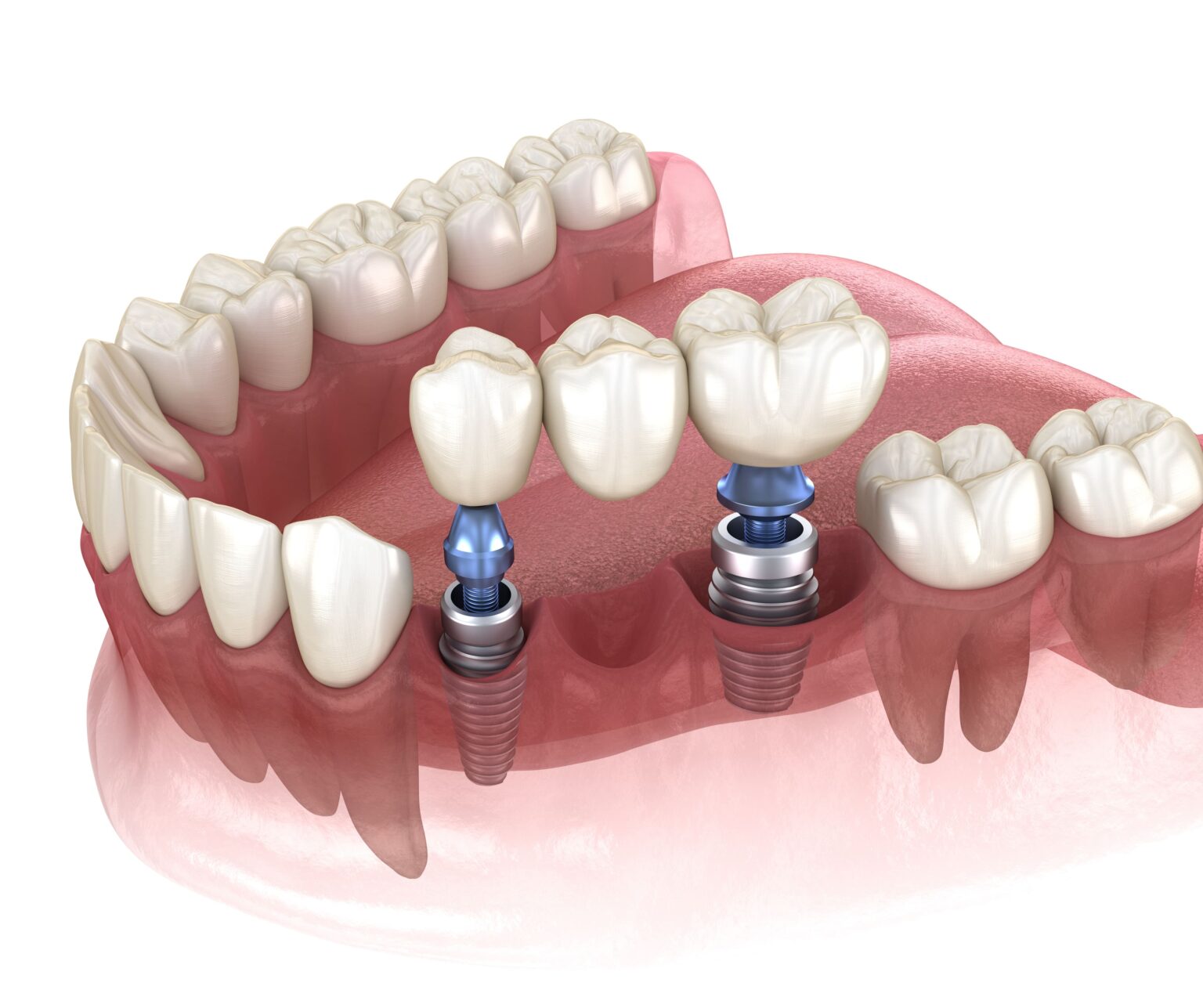 Koszt implantów zębowych w 2026 roku. Od czego zależy cena?